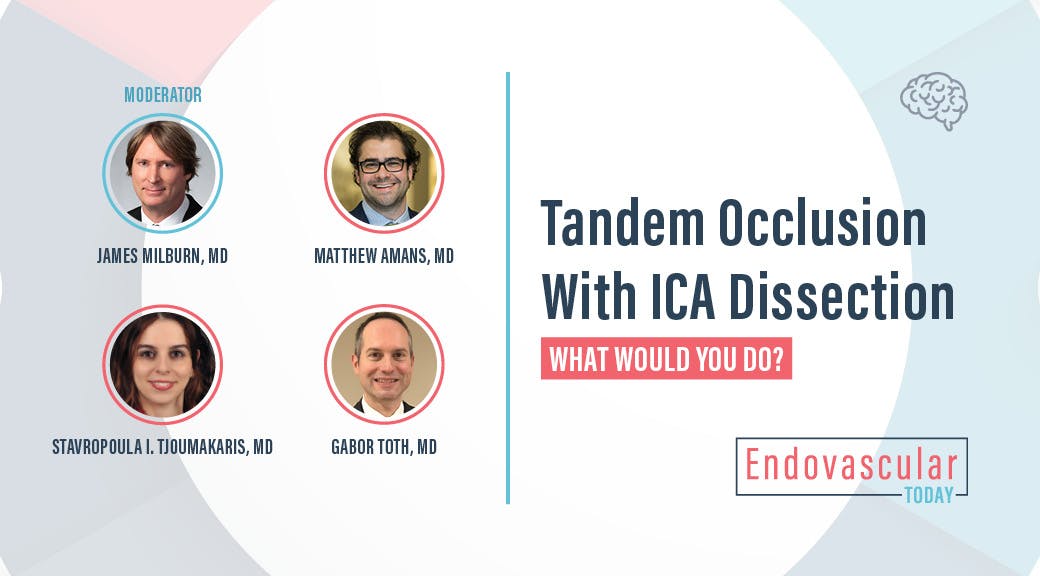Tandem Occlusion With ICA Dissection - Endovascular Today